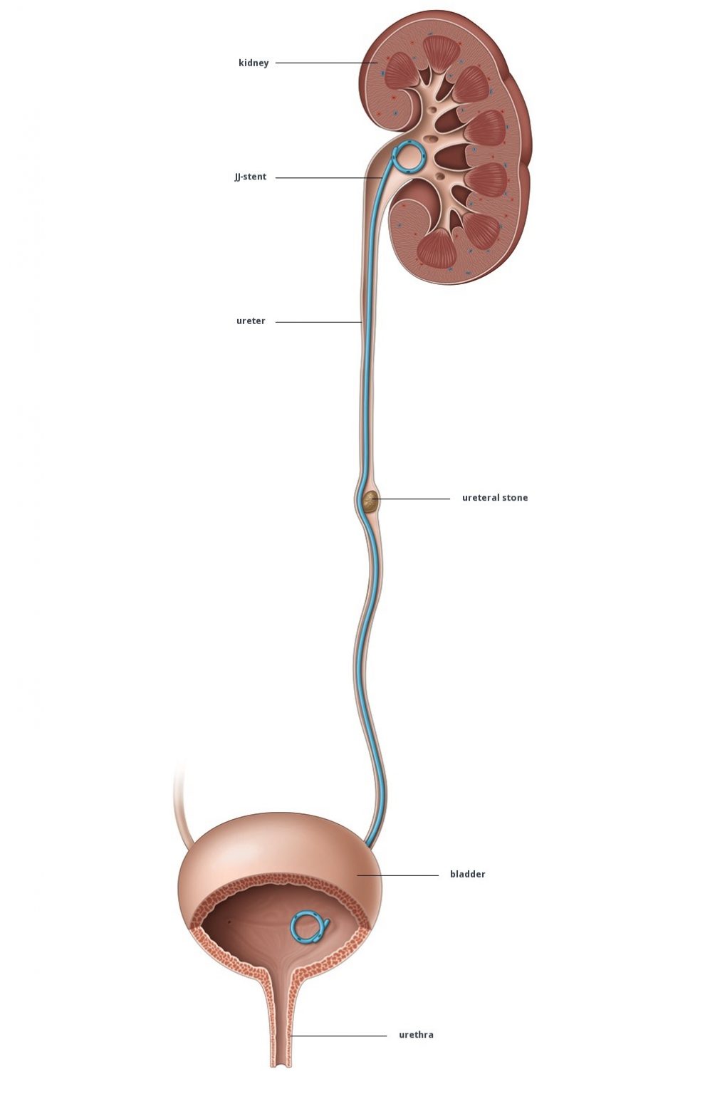 Ureteric Stent Insertion – GM Urology